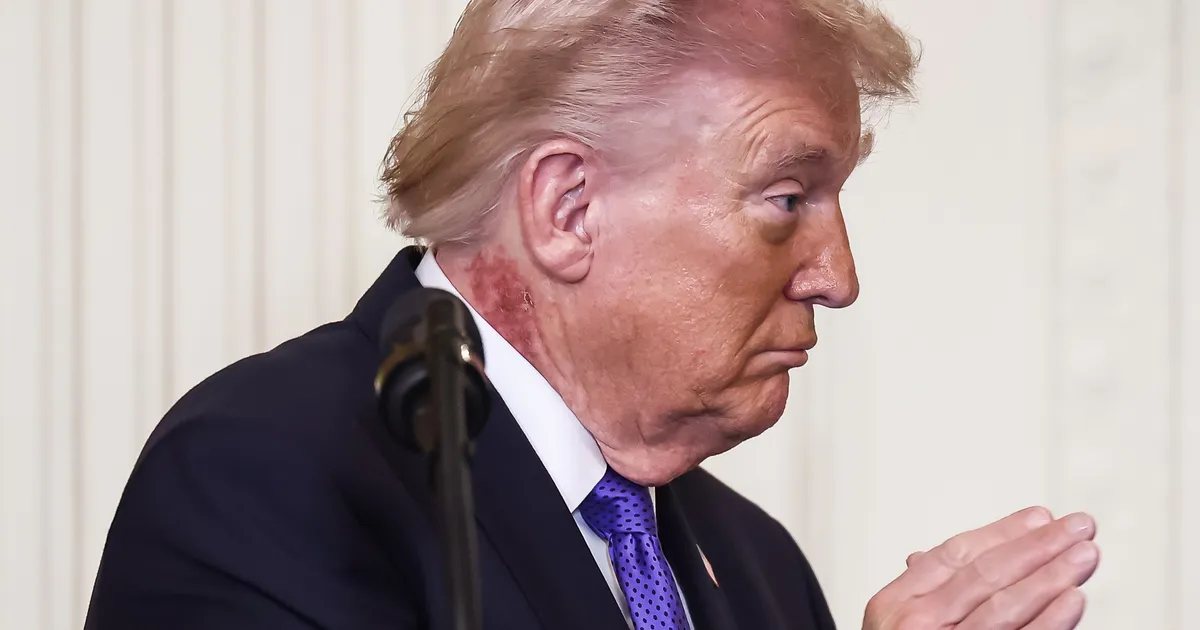 VIDEO Mis juhtus USA presidendi Trumpi kaelaga? Verevalum, lööve või ...